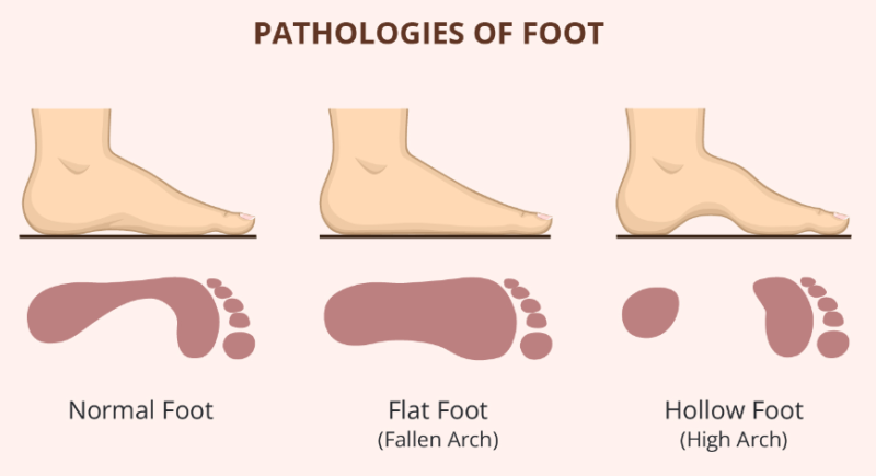 Flat Feet: Causes and Prevention